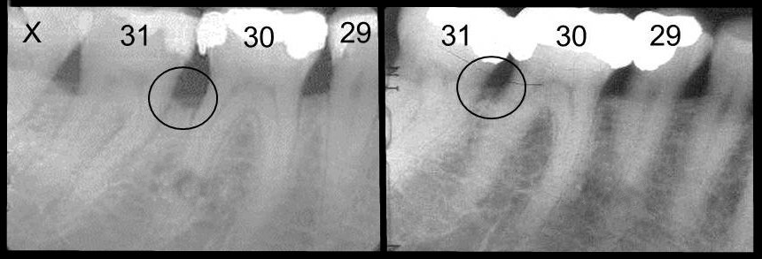 Osseous Surgery – Western Reserve Periodontics